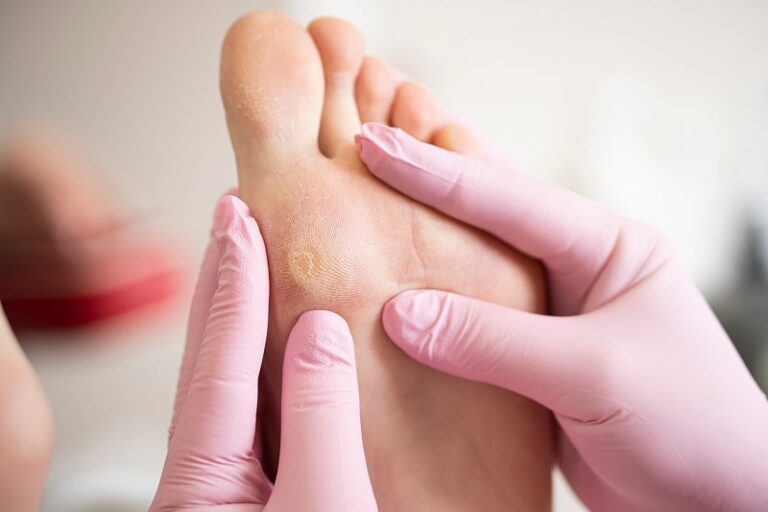 Corns - Markham Foot Care Clinic | Chiropodist Brian Cragg | foot care ...